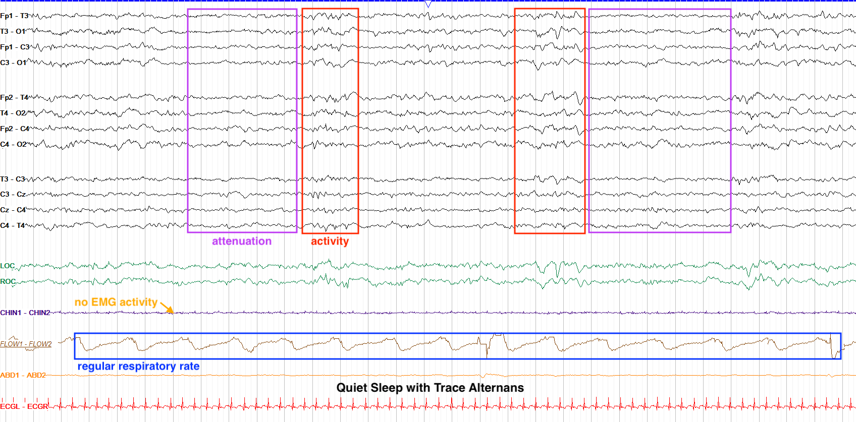 Normal Eeg Tracing